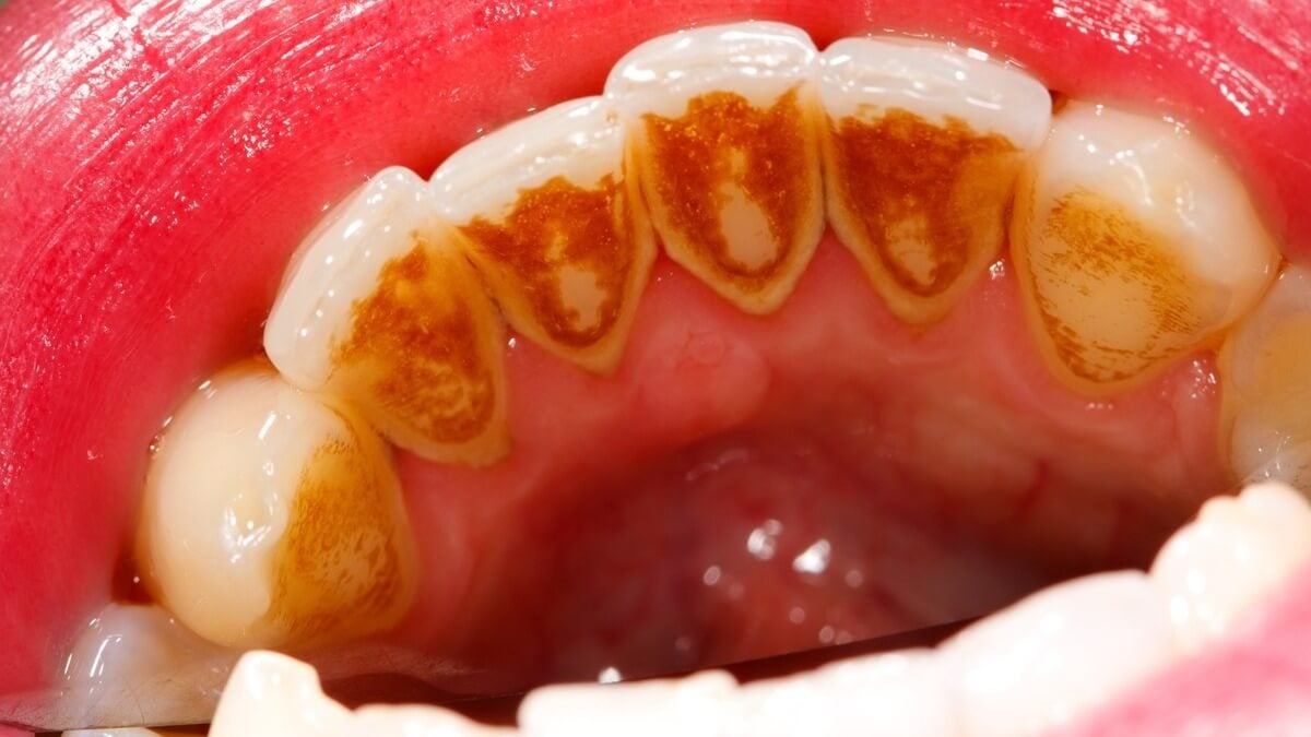 Cómo eliminar y prevenir el sarro de los dientes - Mejor con Salud
