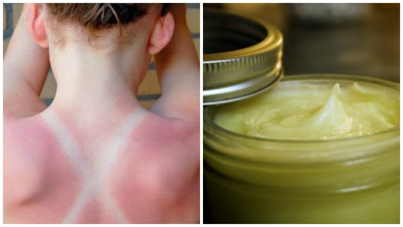 Cómo preparar un ungüento de hierbas y miel para aliviar las quemaduras