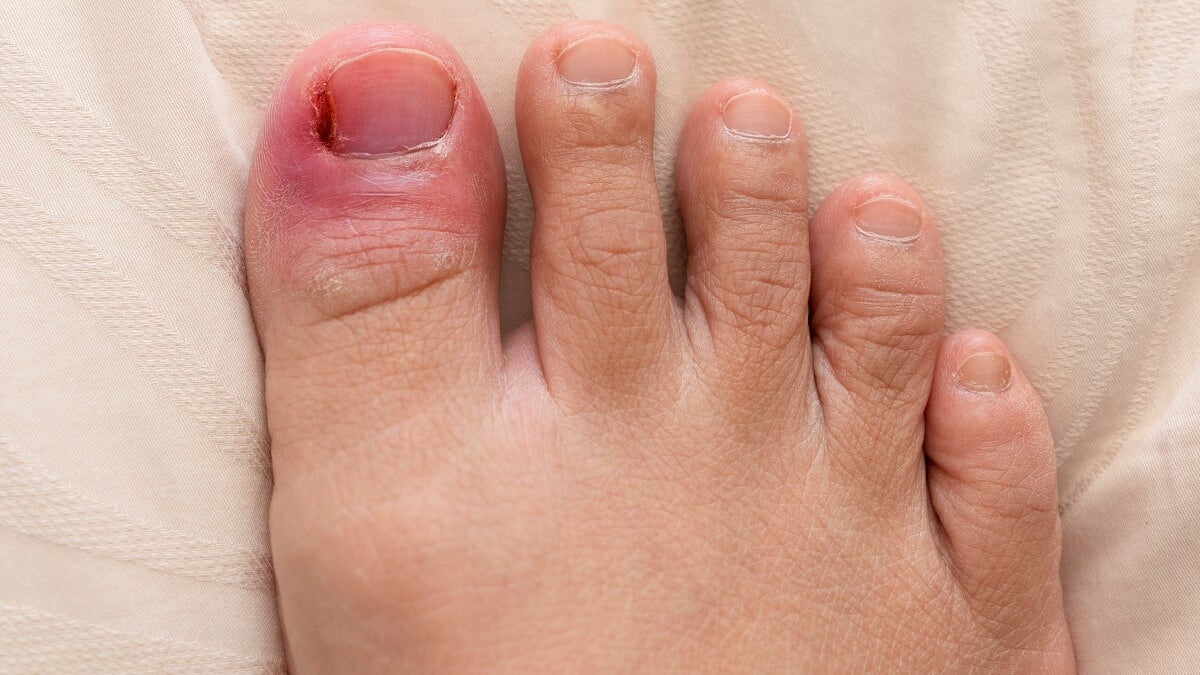 Elimina los uñeros con estos 8 tratamientos naturales - Mejor con Salud