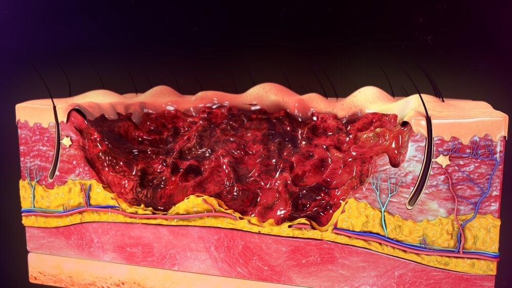 Quemadura de segundo grado: ¿Qué hacer? - Mejor con Salud