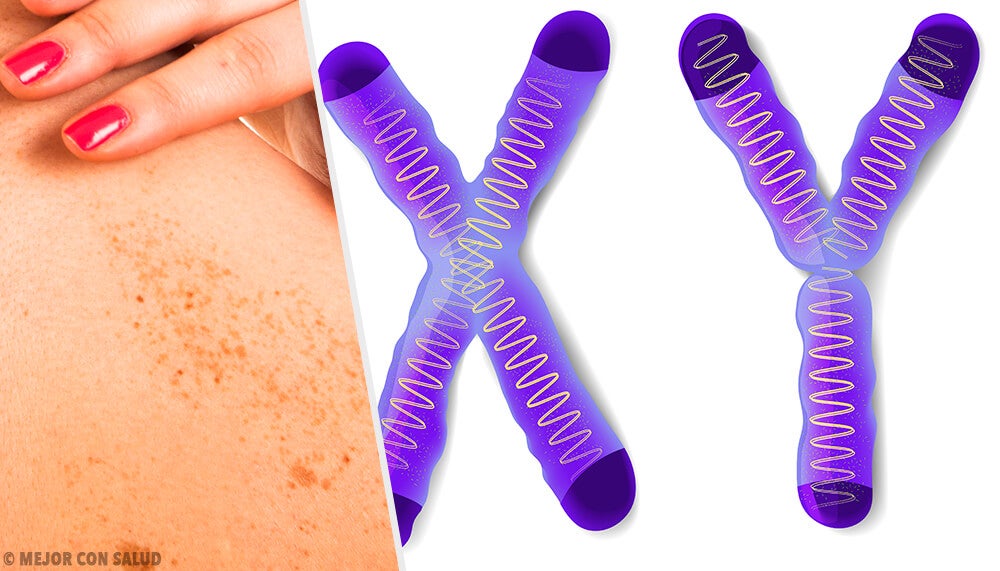 Enfermedad de Albright - Mejor con Salud