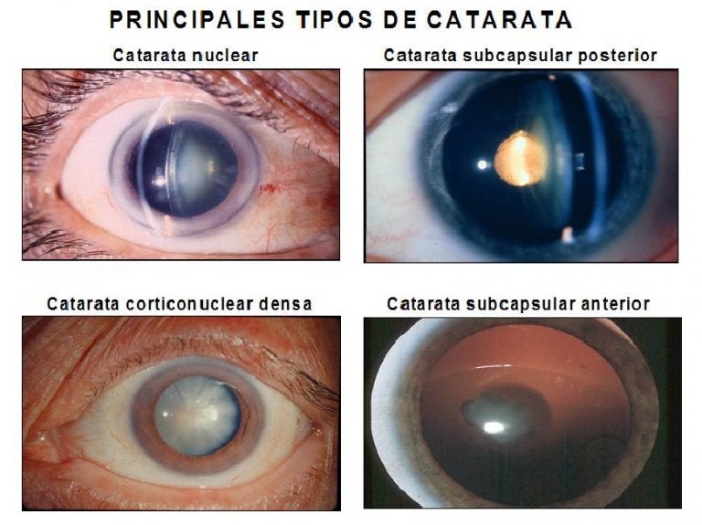 8 síntomas de las cataratas y sus tratamientos naturales - Mejor con Salud