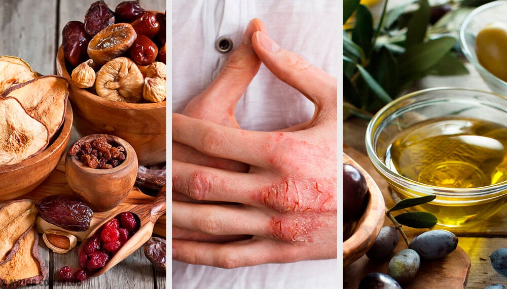 Eczemas de la piel: Causas, síntomas, diagnóstico y tratamiento