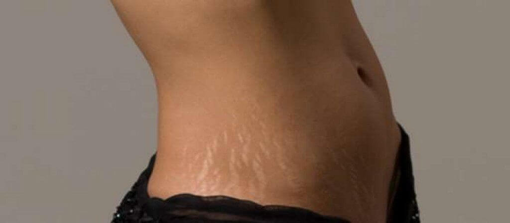 ¿Cómo se pueden tratar las estrías rojas? - Mejor con Salud