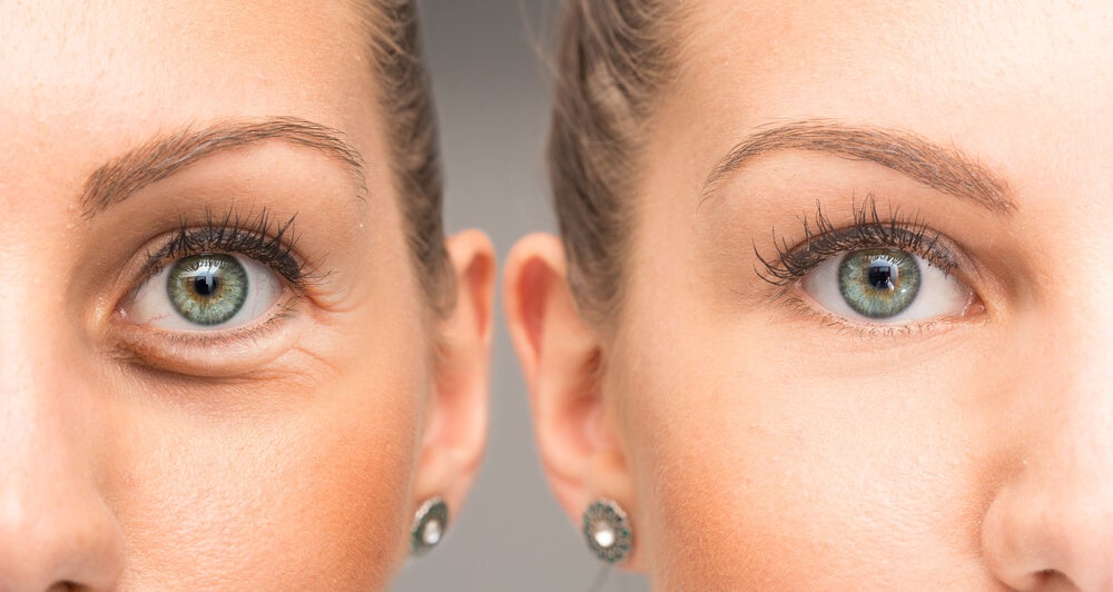 ¿Tus ojos amanecieron hinchados? 5 remedios rápidos para aliviarlos