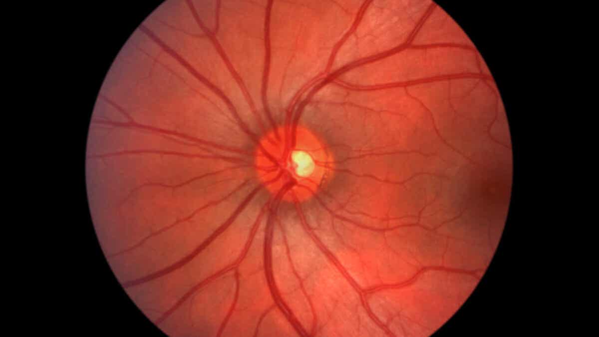 Qu Es El Edema De Papila papiledema Mejor Con Salud qu-es-el-edema-de-papila-papiledema-mejor-con-salud