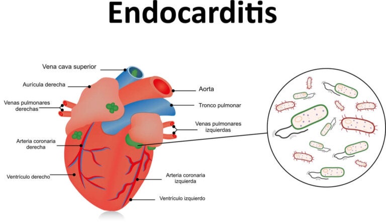 Endocarditis: una infección en el corazón - Mejor con Salud