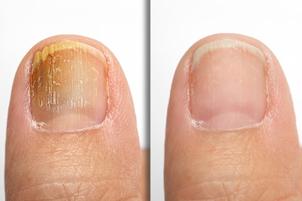 7 maneras de prevenir una infección por hongo en las uñas - Mejor con Salud