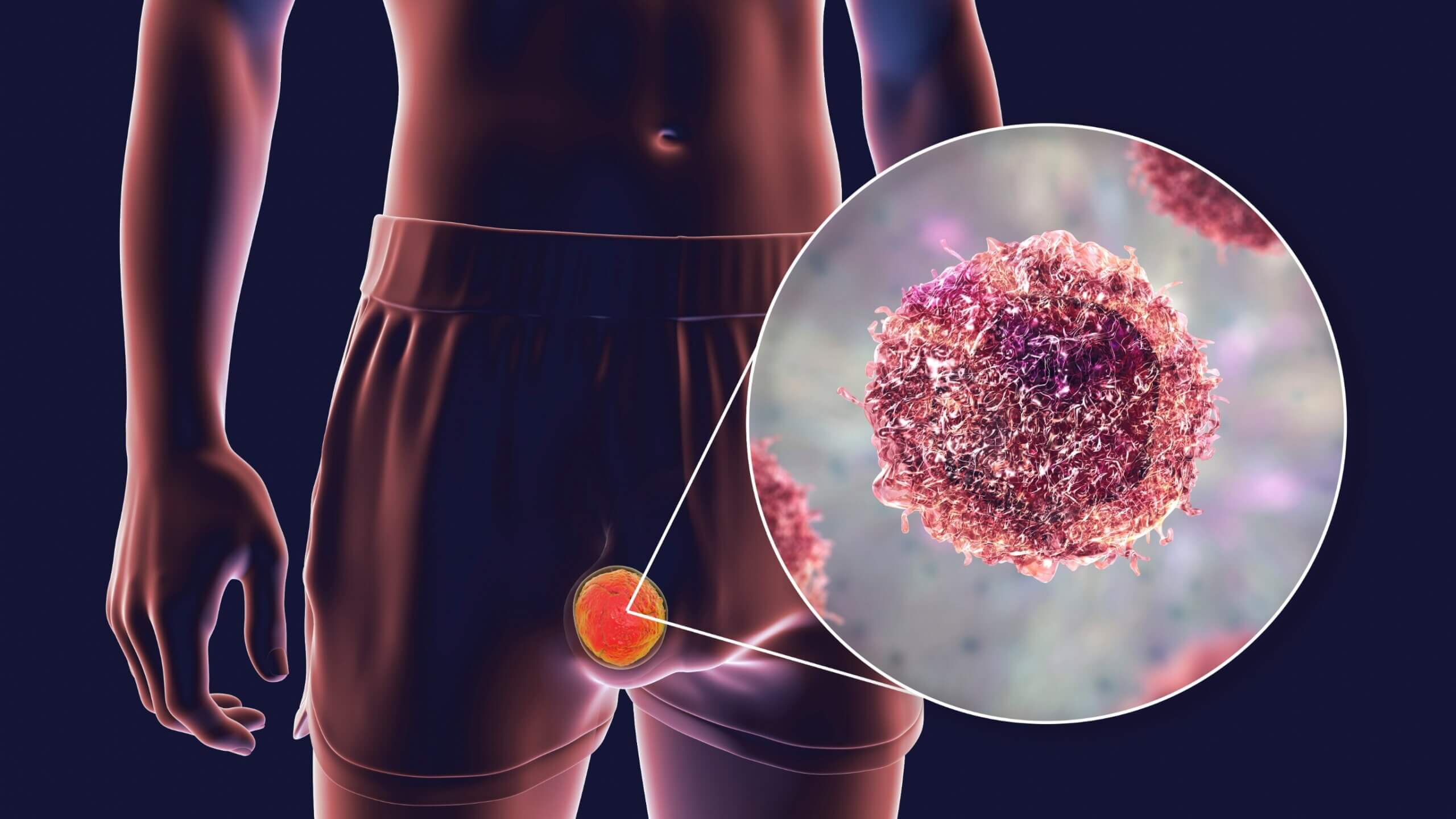 Teratoma: tipos, síntomas y tratamientos - Mejor con Salud