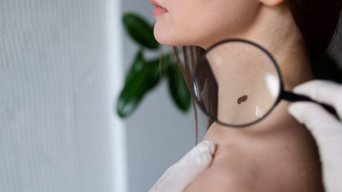 ¿Por qué aparecen las verrugas en el cuello y cómo eliminarlas? - Mejor ...
