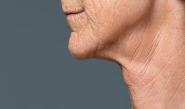 ¿Por qué sale papada, qué tipos existen y cómo prevenirla?