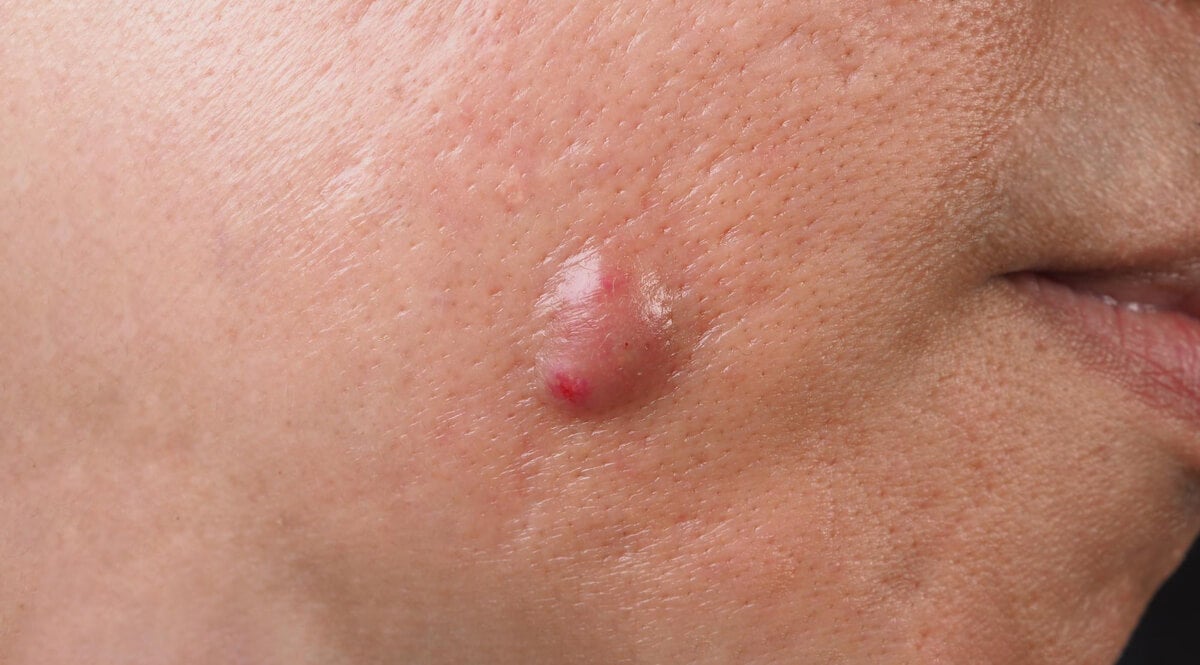 9 causas de las pústulas en la piel y cómo tratarlas - Mejor con Salud